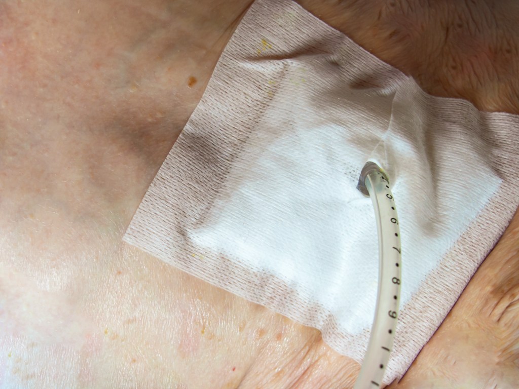 Entzündungen rund um die PEG-Sonde erkennen, behandeln und vorbeugen